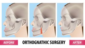 Orthognathics - Irvine Pediatric Dentistry & Orthodontics